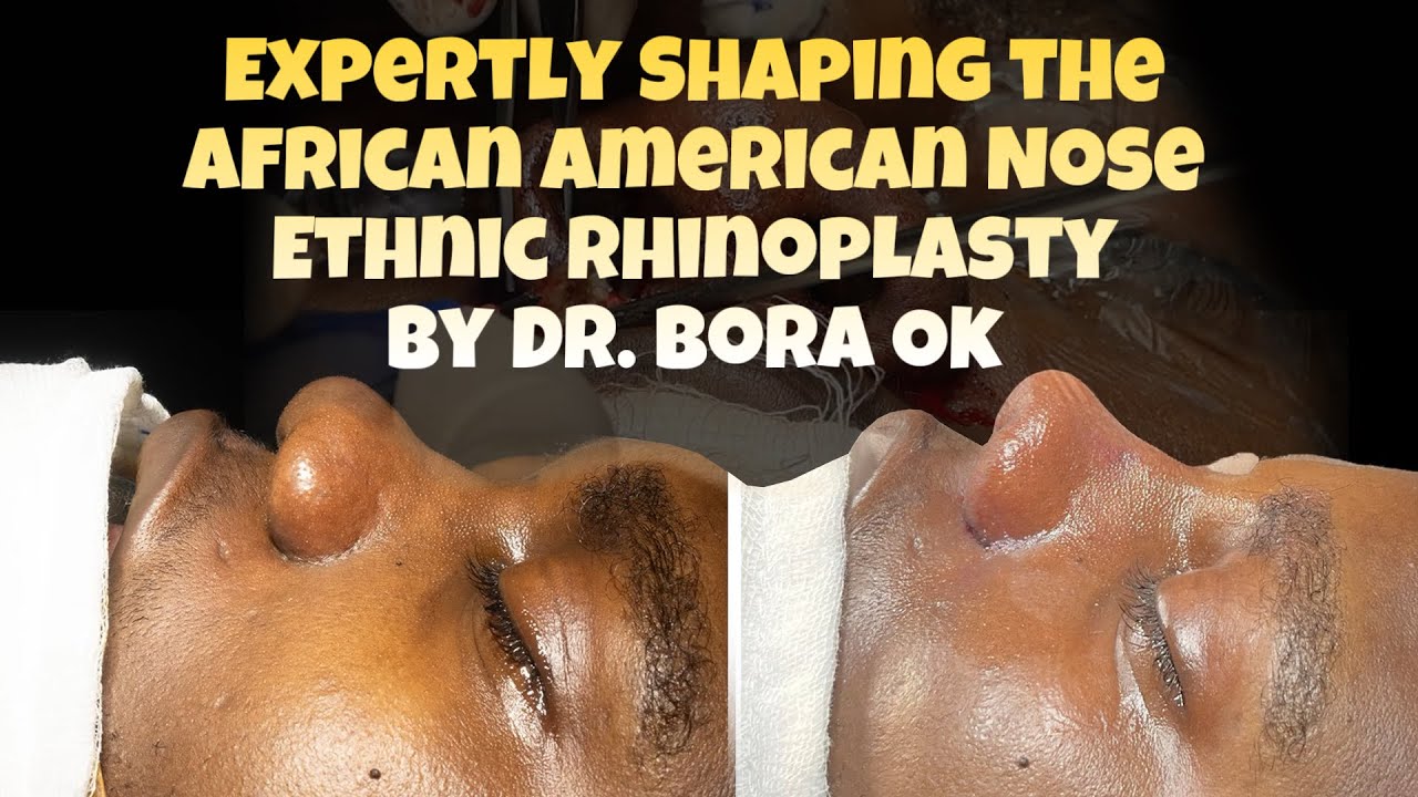 Expertly Shaping the African American Nose | Ethnic Rhinoplasty by Dr ...