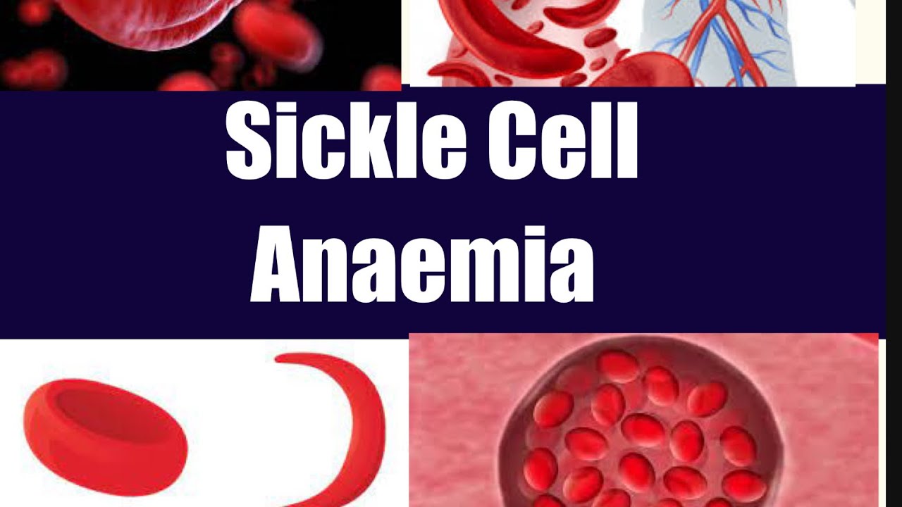 Sickle cell anaemia. Detailed lecture. Biology - YouTube