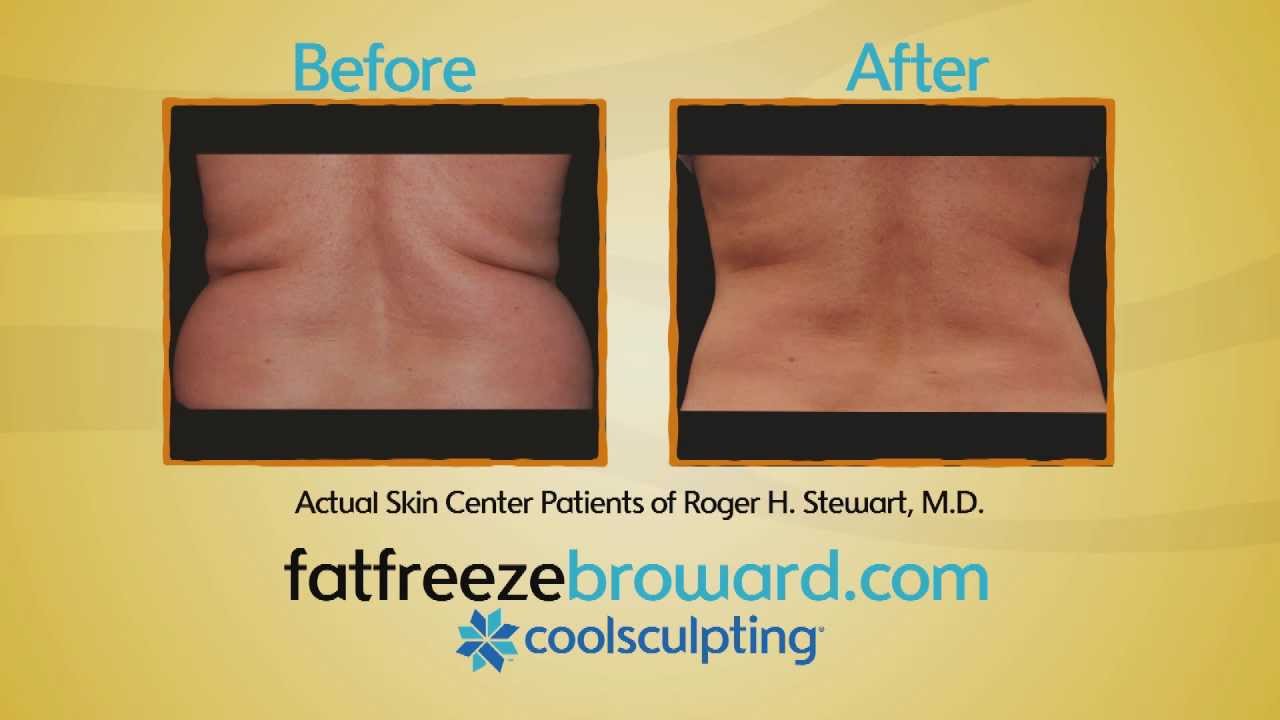 CoolSculpting - Non-Invasive Fat Removal Procedure - Skin Center ...