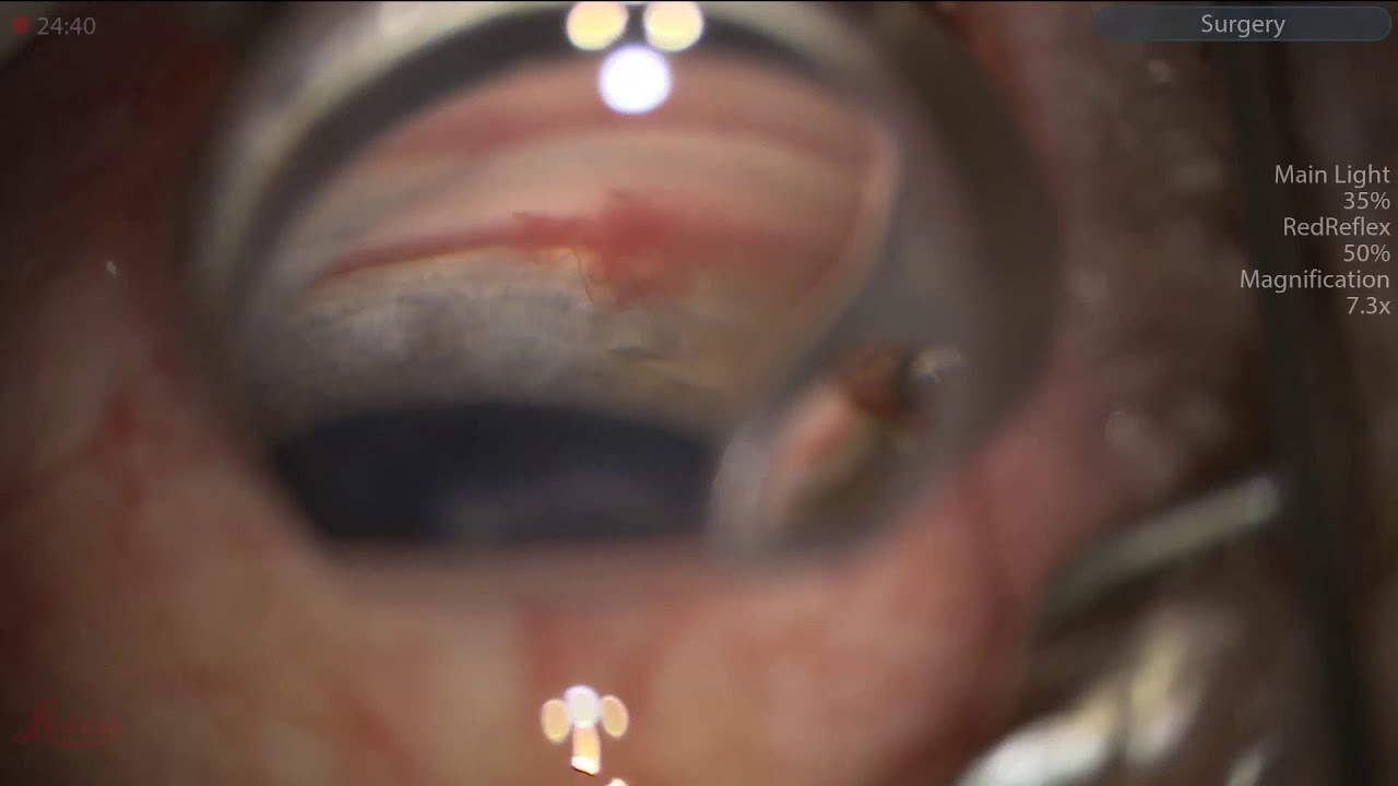 Phaco/OMNI - 360 degree viscocanaloplasty with 180 degree goniotomy ...