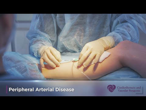 Limb Preservation and Amputation Prevention | Peripheral Arterial Disease | CTVS Texas