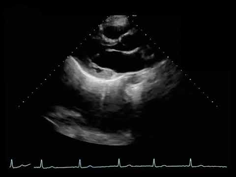 PLAX increased depth - YouTube