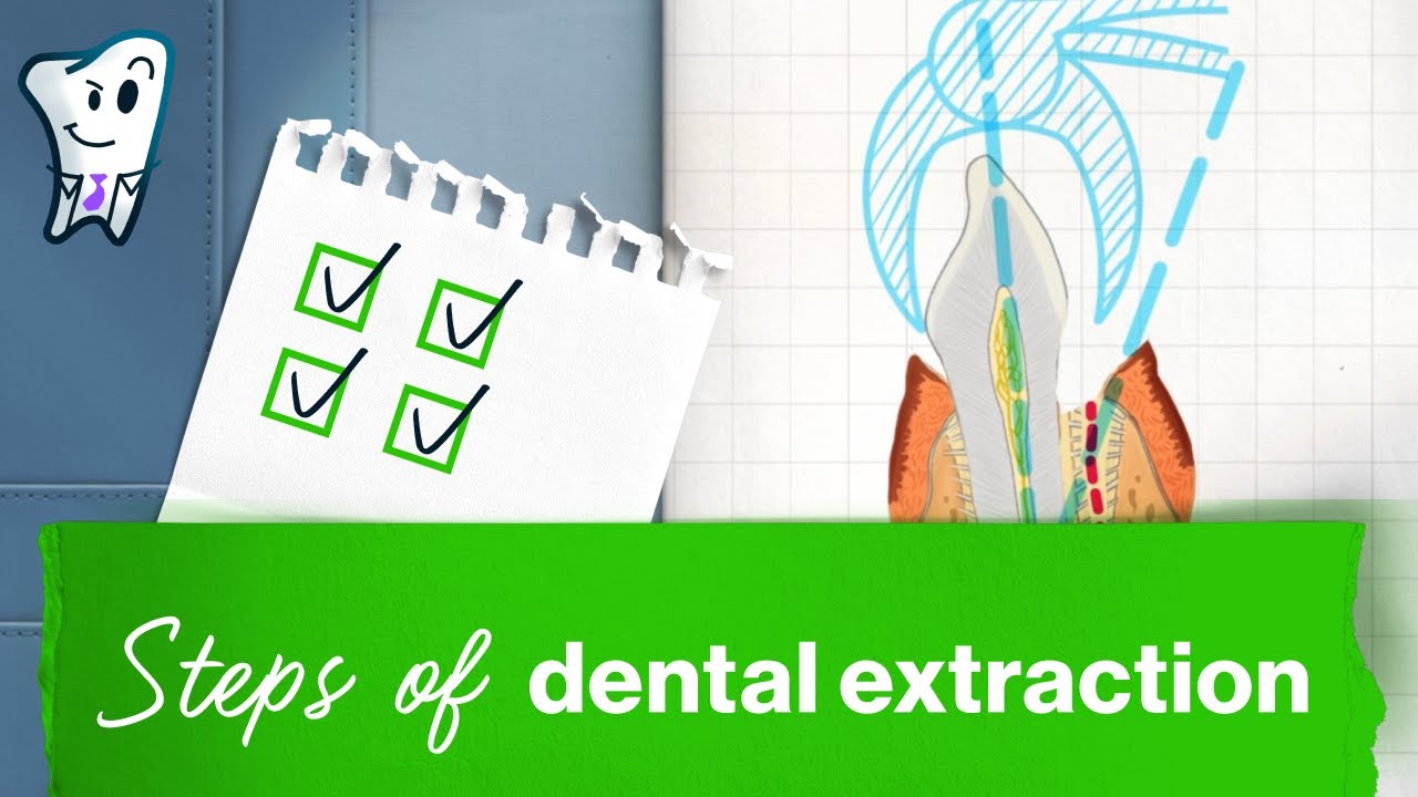 Steps of Tooth Extraction: 1) syndesmotomy, 2) instrument ... - YouTube