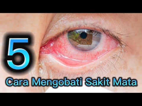 5 Cara Mengobati Sakit Mata Paling Ampuh