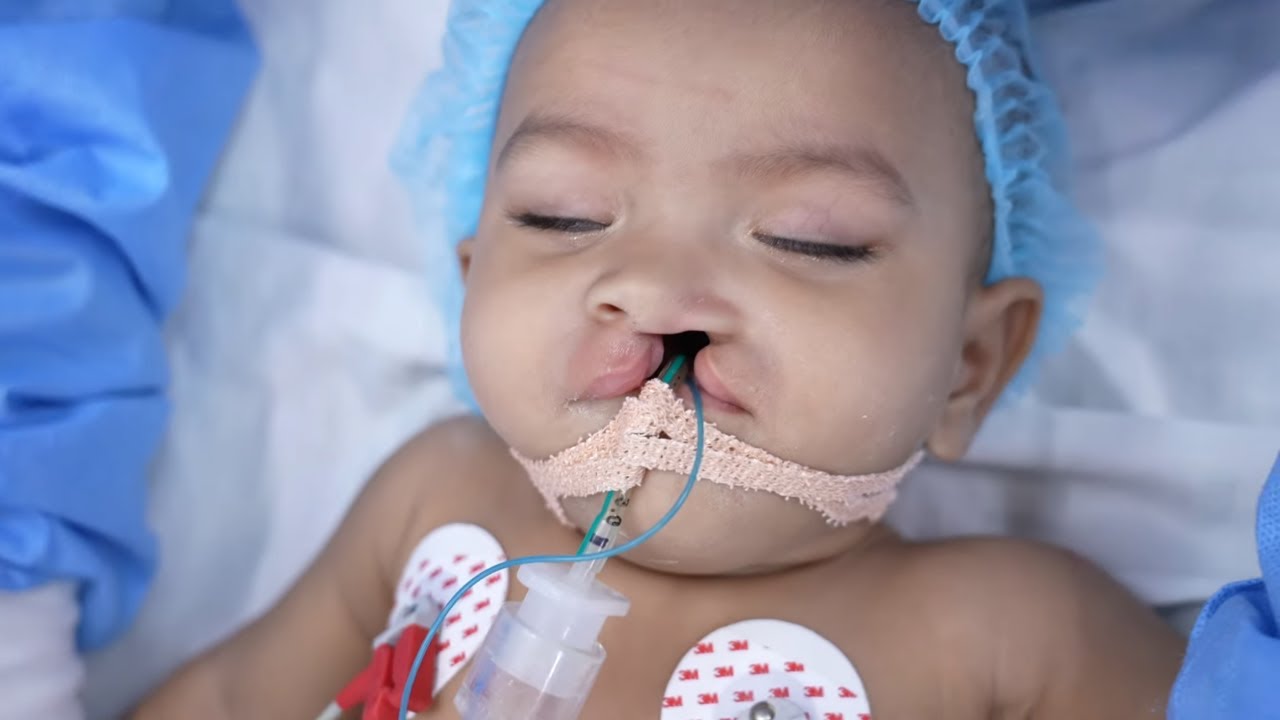 Baby with Cleft lip going for Surgery - Anesthesia - YouTube