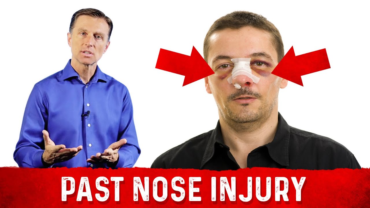 Post Nose Injury – Headache Pain Relief – Acupressure Techniques by Dr ...