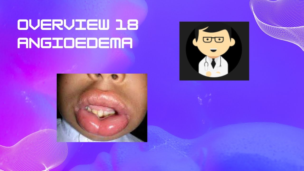 Overview 18 : Angioedema - YouTube