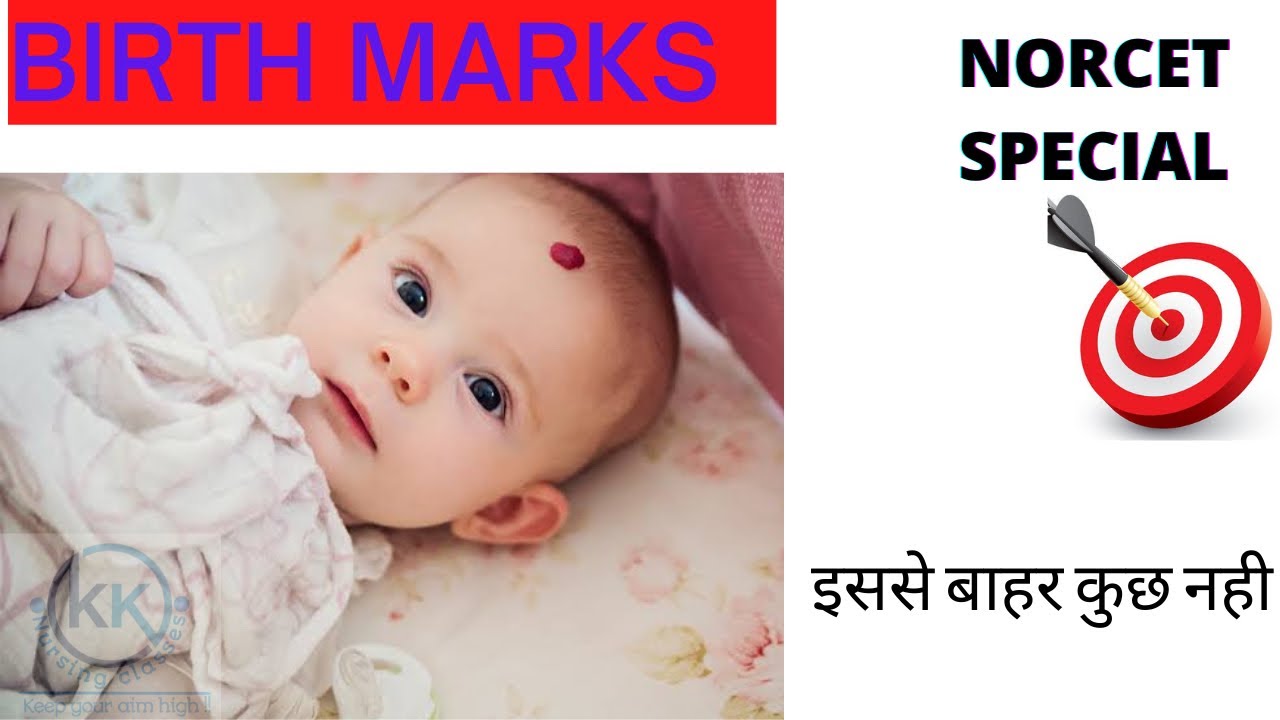 Birth mark | Important birthmarks | Child health nursing | Pediatric ...