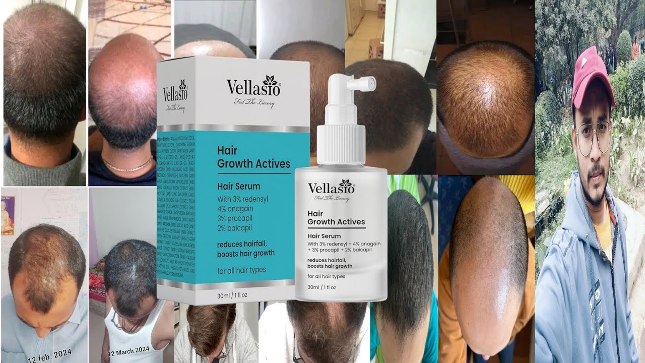 Vellasio Hair Growth Serum | Honest Review - YouTube