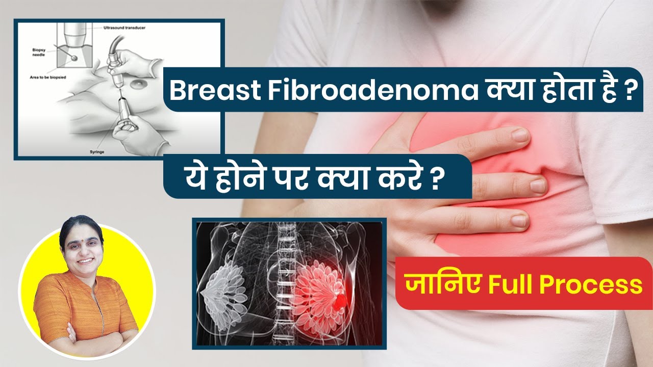 Breast Fibroadenoma in Hindi, Causes, Causes, Symptoms, Diagnosis ...