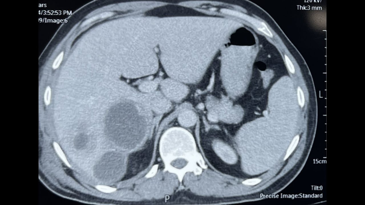 Laparoscopic liver abscess drainage form segment VII and VI - YouTube