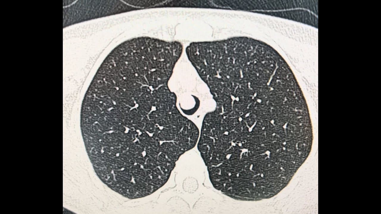 World's first case of non intubated uniportal robotic tracheal ...