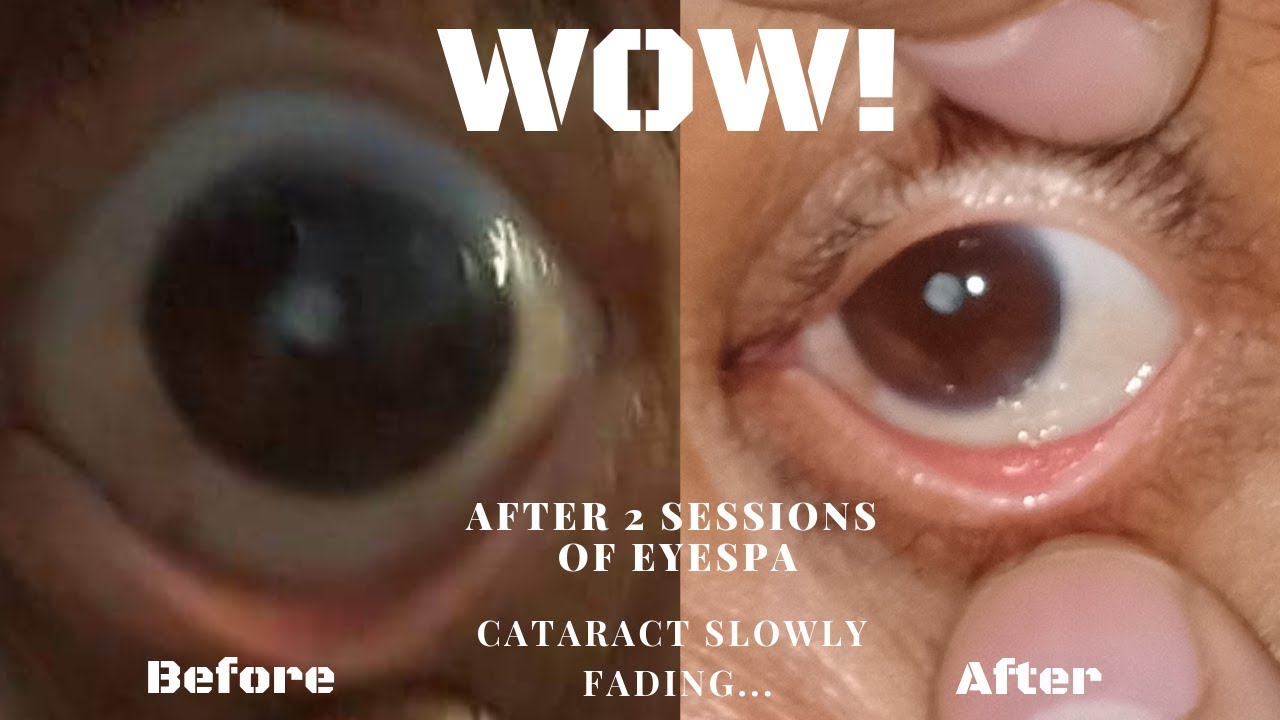 FYEO® - Left Eye Cataract SLOWLY FADING AFTER 2 SESSIONS - YouTube
