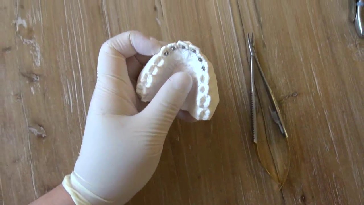 Tiggle Wire insertion - YouTube