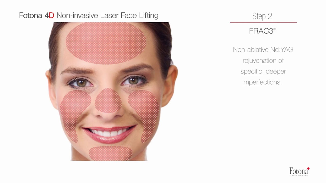 Fotona 4D Non Invasive Laser Facelift - YouTube