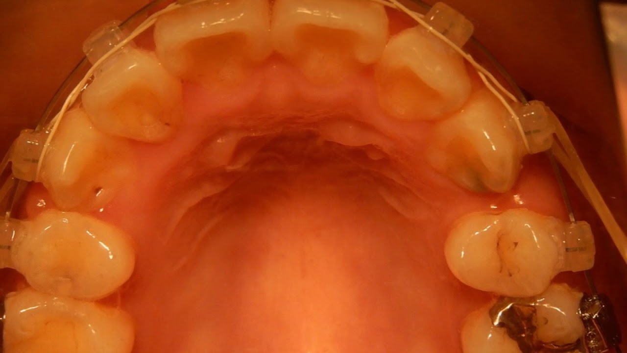 Orthodontic libraryHK. Dental crowding Chart No.4945 - YouTube
