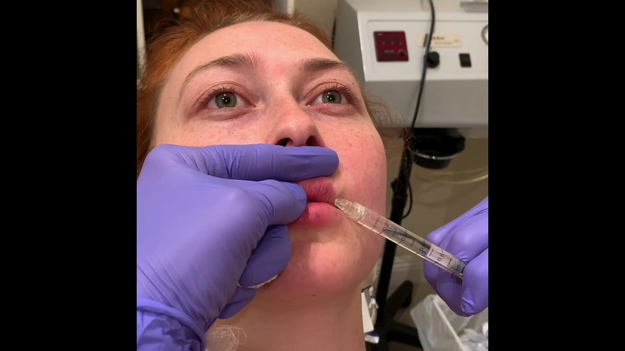 Restylane Refyne Lip Fillers - YouTube