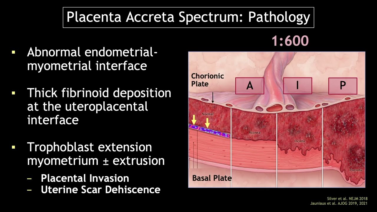 Placenta Accreta Spectrum: Sonographic Markers in Early Gestation by ...