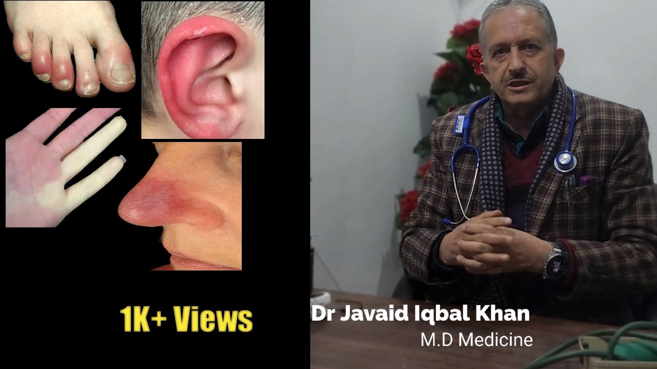 CHILBLAINS, (Pernio) is an inflammatory skin changes due to repeated ...