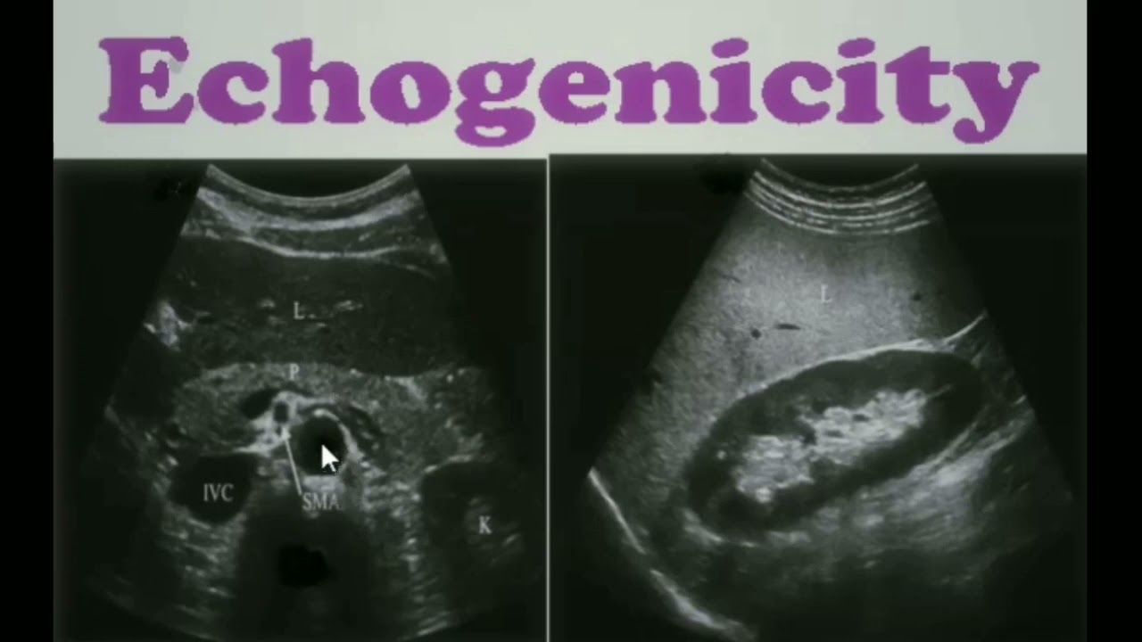 Understanding Echogenicity on Ultrasound: What Does It Mean ...