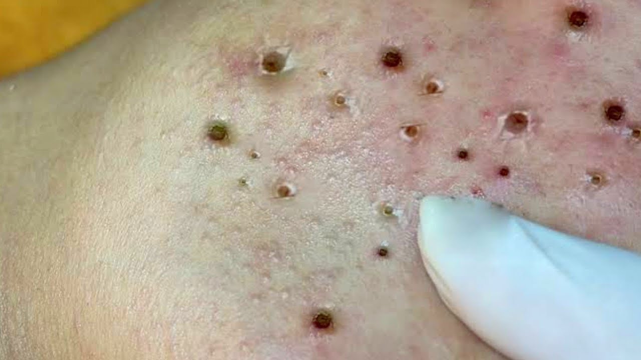 Extreme Big Blackhead Removal #005 - YouTube