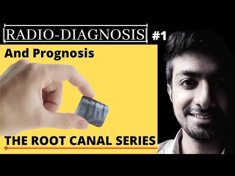 Radiographic interpretation before RCT| How it can help? | Basic Root ...