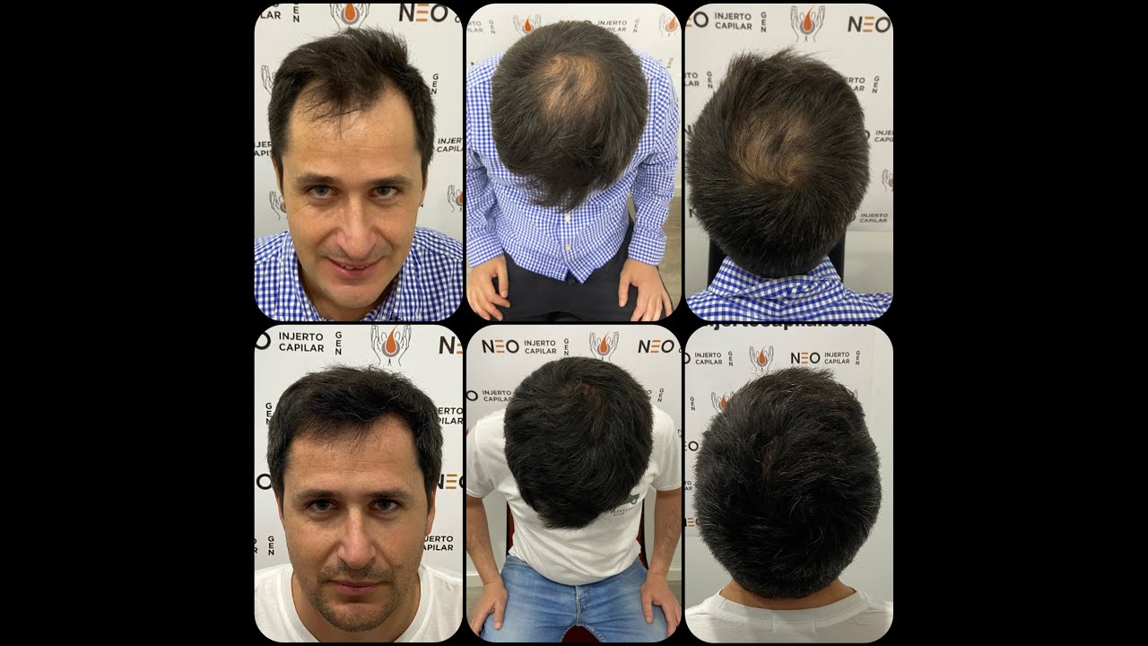 Primera Línea Frontal + Coronilla. Naturalidad y alta densidad son las ...