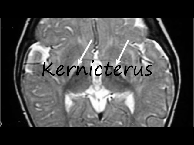 Kernicterus Mri