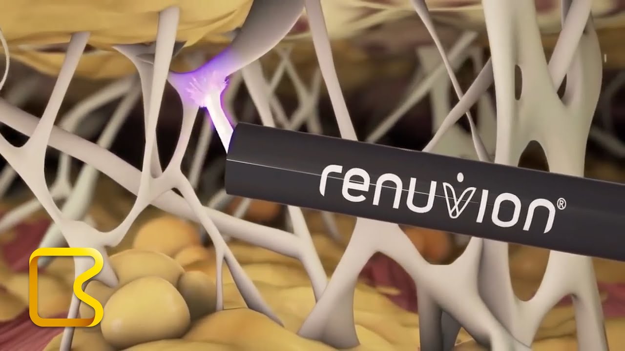 J Plasma – Liposucción con mejor tensión de piel (Proceso) - YouTube