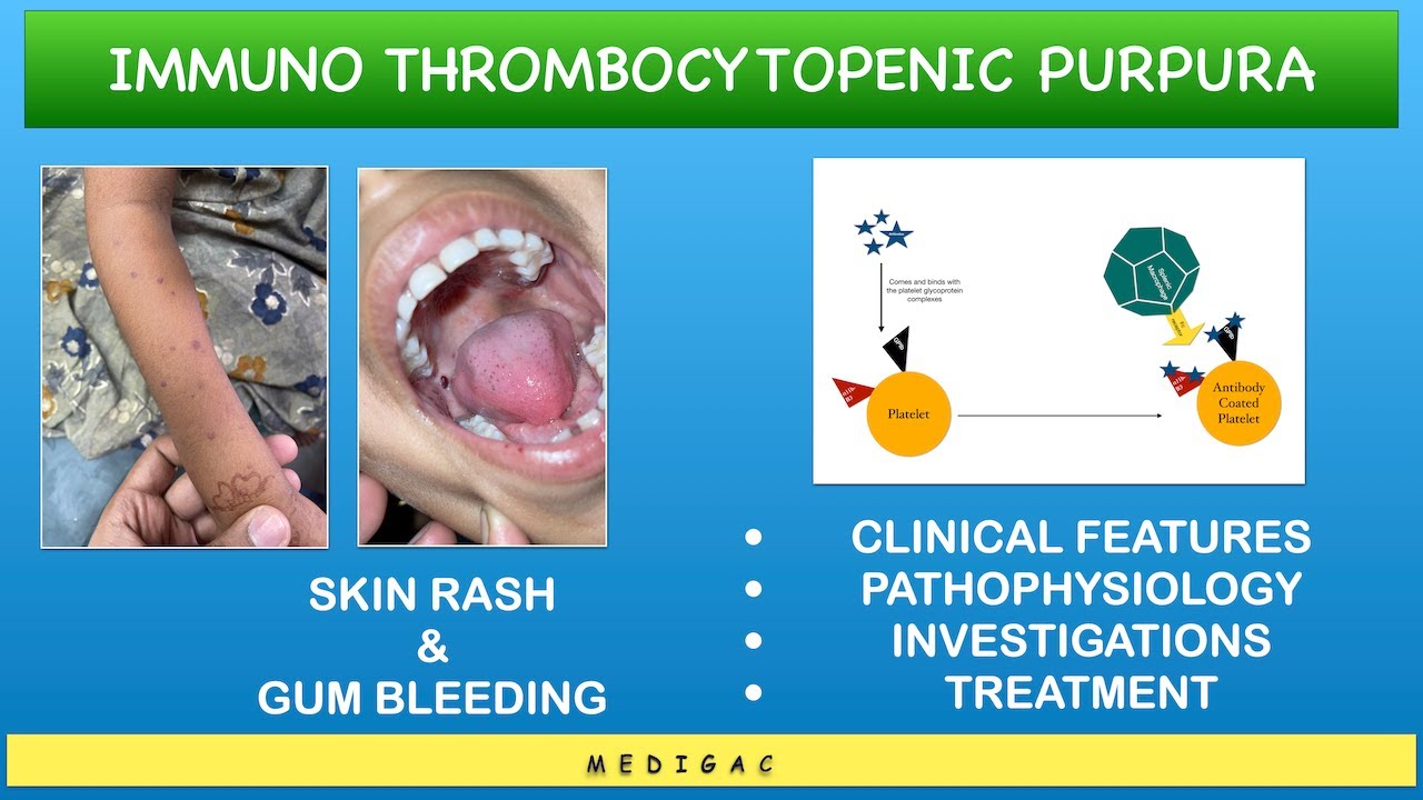 Idiopathic Thrombocytopenic Purpura Antibodies