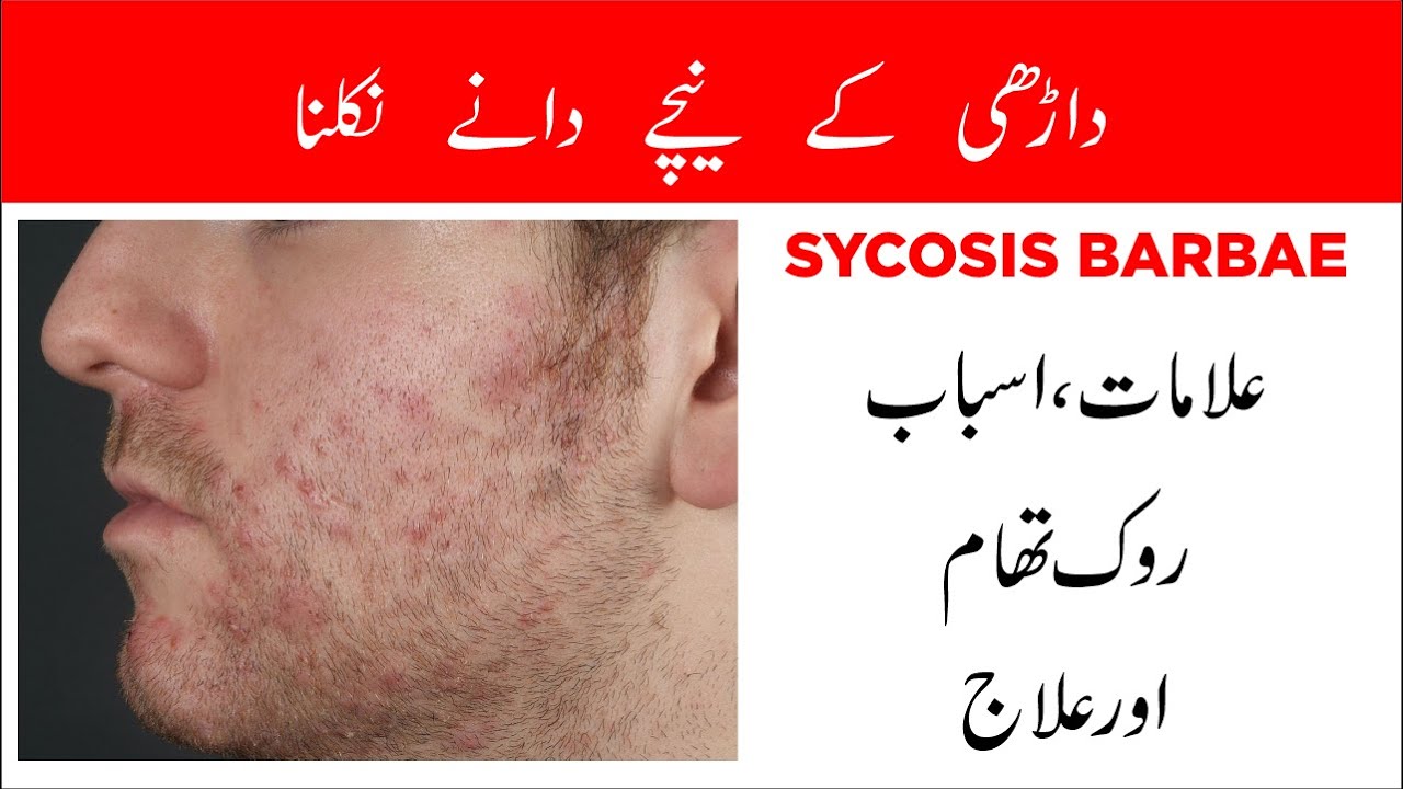 Sycosis Barbae | Repeated infection of beard area | داڑھی کے علاقے کا ...
