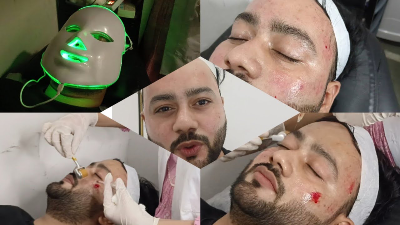 Skin Glow Micro Needling With PRP Full Vlog | Must Watch #vlog #face # ...