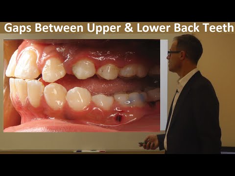 Why Do We have Gaps Between Upper & Lower Back Teeth & Its Link with ...