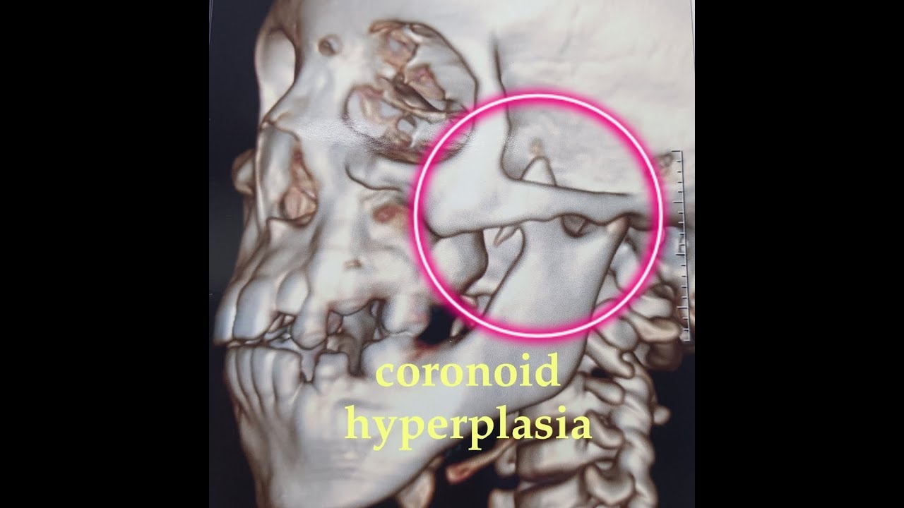 Coronoidectomy for coronoid hyperplasia by dr. Mohamed Hasan Osman ...