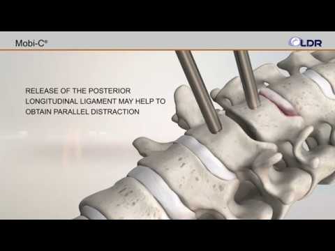 Mobi C Cervical Disc — Technique Animation - YouTube
