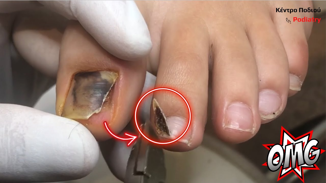 Nail|Traumatic nail treatment|Θεραπεία τραυματισμένου νυχιού|Ποδιατρική ...