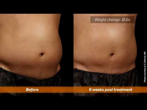 SculpSure - Electrik Image Spa - How it works - Toledo, Detroit, Monroe ...