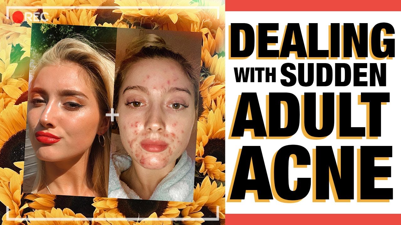ME AND MY ACNE // HOW I DEALT WITH GETTING SUDDEN ADULT ACNE - YouTube