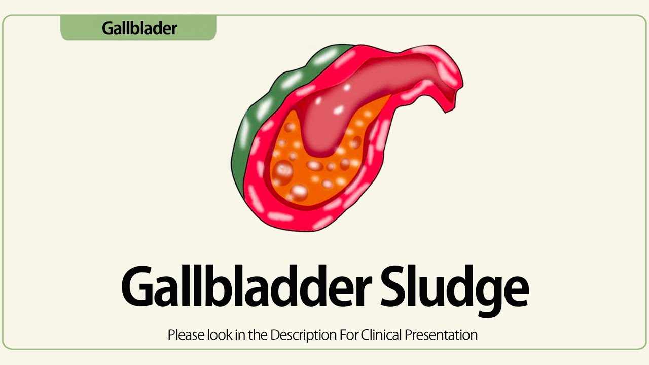 Linear EUS: Gallbladder Sludge - YouTube