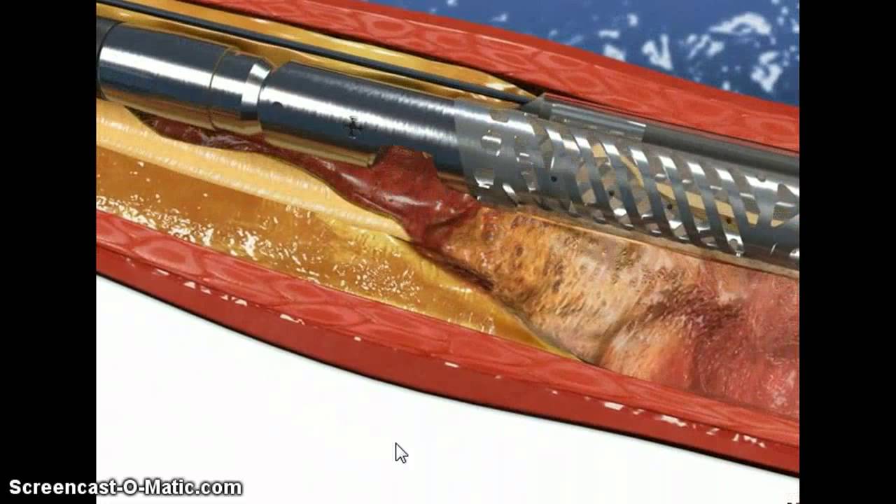 Atherectomy - YouTube