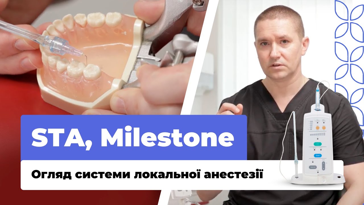Огляд системи локальної анестезії STA System – комфортно для ...