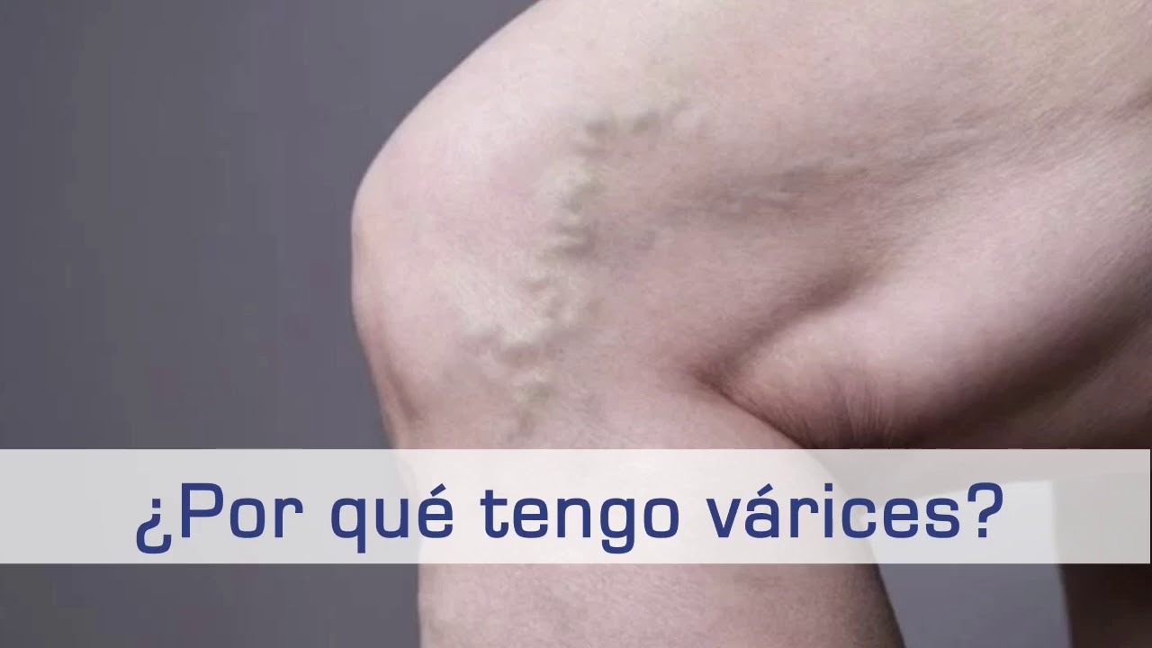 Varices - YouTube