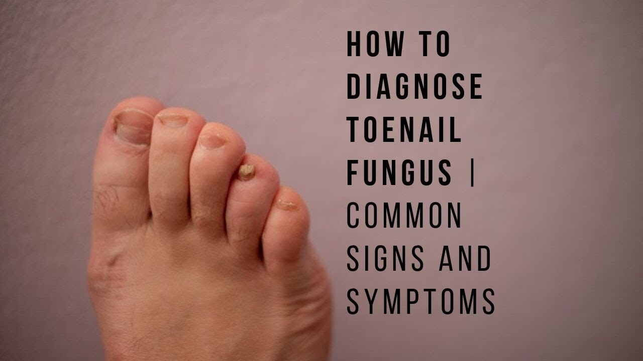 How to Diagnose Toenail Fungus Common Signs and Symptoms - YouTube