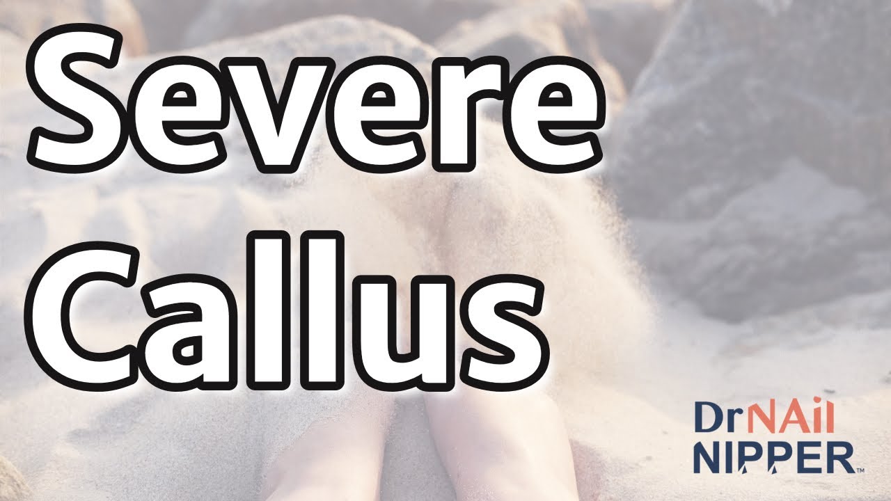 How to treat severe calluses on feet? Callus Tuesday. Severe Callus ...