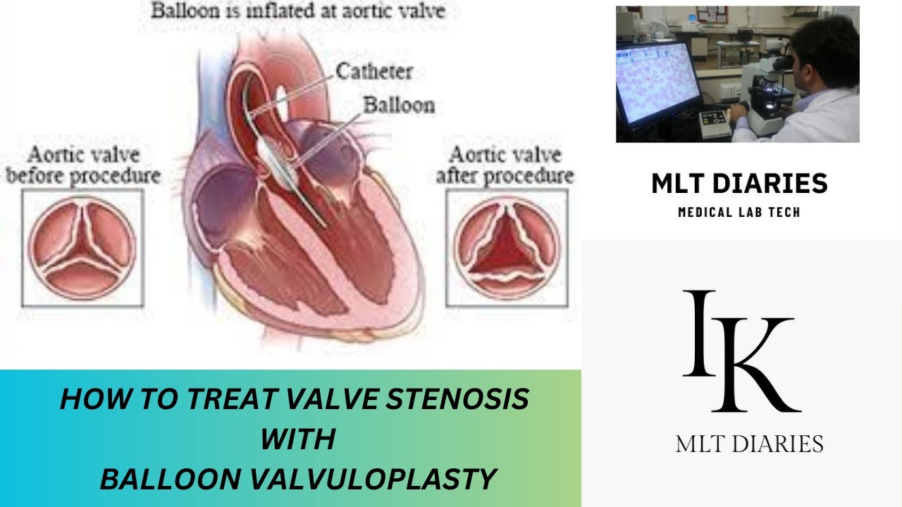 treat valve stenosis with balloon valvuloplasty //Indications ...