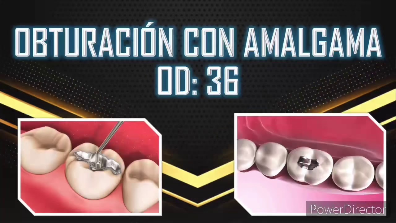 Obturación Con Amalgama 🦷 (CEUMH) 💙💚 - YouTube