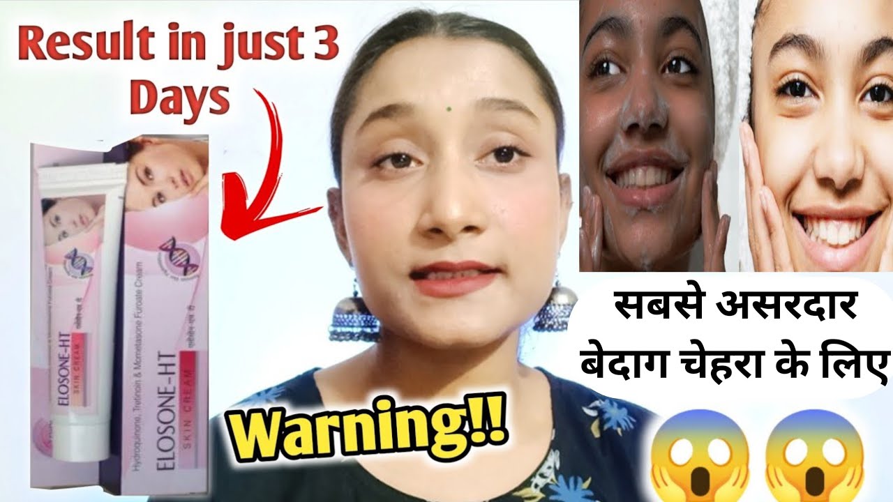 Elosone HT cream review|Best cream for pigmentation|Darkspot, tanning ...