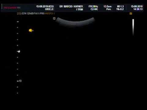 Nícolas - ultrassom 13 semanas Dr. Marcio Karner - YouTube