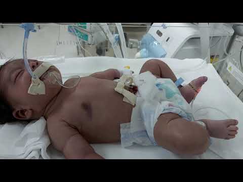 Case 285 neonatal seizures due to perinatal asphyxia, HYpoxic ischemic ...