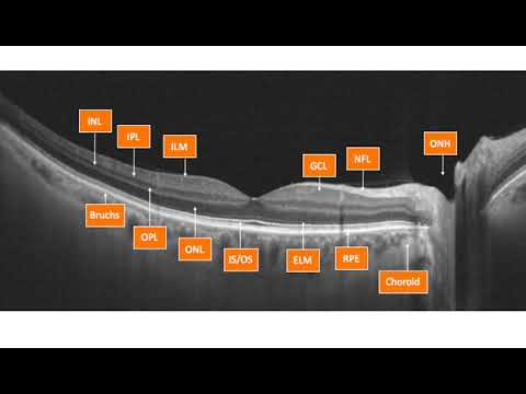 Optovue OCT Interpretation Session 1 OCT Introduction to SD OCT - YouTube